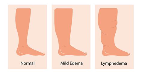 Leg Lymphedema Treatment Options Reduce Pain Swelling Leg Edema