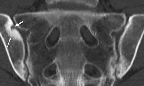 Mri Based Synthetic Ct In The Detection Of Structural Lesions In Patients With Suspected