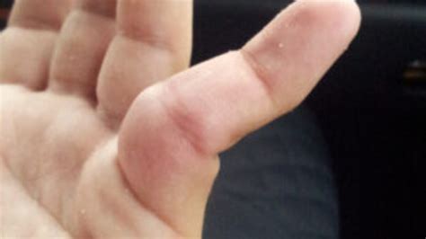 Minor Dislocation Of Finger