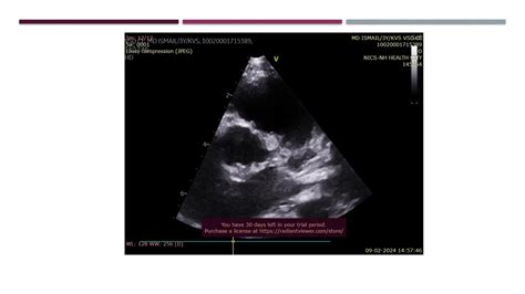 Segmental Analysis Of Cardiac Defects Ppt Pptx Heart And