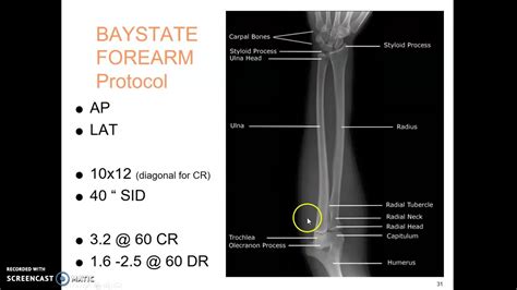 Forearm X Ray Protocol Youtube