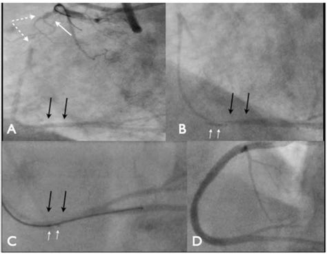 An Occlusion Of A Rca With Ambiguity Of The Proximal Cap Panel A Download Scientific Diagram