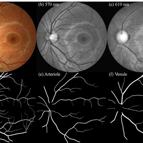 A Typical Color Fundus Image Left With Annotated Arterioles And Download Scientific Diagram