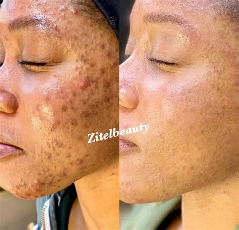 Still Battling With Hyperpigmentation You Cant Rock Your Bare Face Without Makeup Or Filter