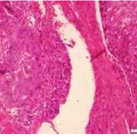 The Section Shows Neoplastic Tissue Containing Cells With Round To Oval Download Scientific