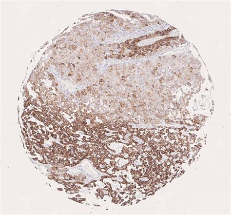 Cytokeratin 7 (CK7) scoring in patient-derived lung xenografts