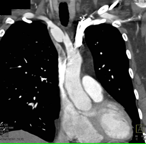 Right Subclavian Artery Aneurysm And Dissection Vascular Radiology