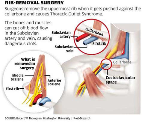 Rib Removal Surgery For Thoracic Outlet Syndrome Pregnant Center