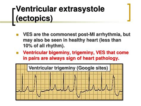 Broad Complex Tachycardia Ppt Download