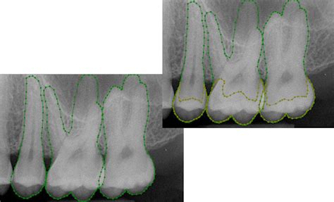 Do Dental X Ray Image Segmentation By Dentalannotator Fiverr