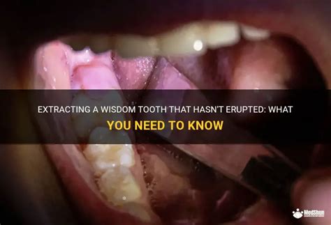 Extracting A Wisdom Tooth That Hasnt Erupted What You Need To Know