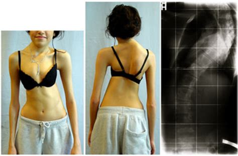 Patient With Failure Of Segmentation Without Decompensation Due To