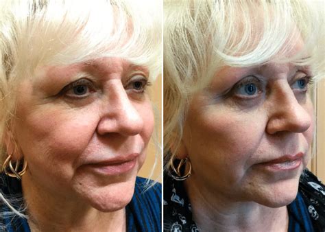 Voluma Juvederm And Botox Liquid Facelift For Nonsurgical Instant