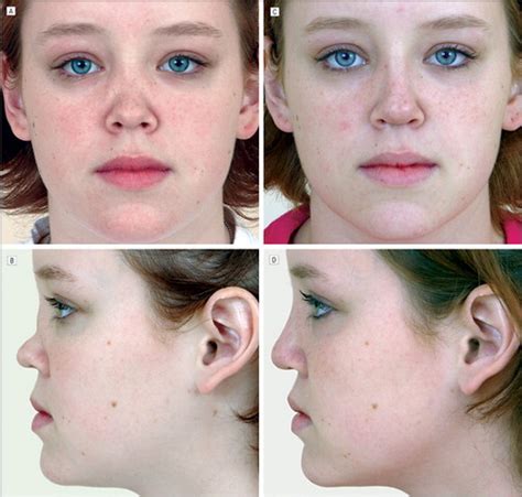 Coke Nose Before And After