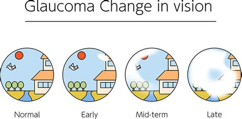 Glaucoma Management In Fort Lauderdale 33064 Glaucoma Management