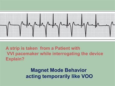 Pacemaker Ecgs Yasmeen Kamal Pptx