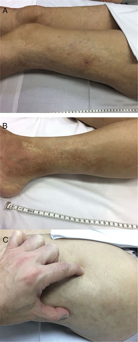 Linear Morphea Lineare Zirkumskripte Sklerodermie Altmeyers