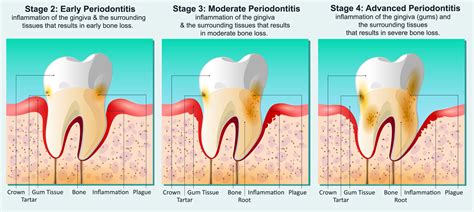 Gum Disease Treatments