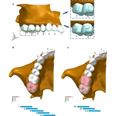 Three Dimensional Fea Model For Molar Distalization A Maxillary Arch Download Scientific