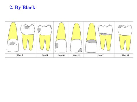 Etiology And Pathogenesis Of Dental Caries Classification Of Caries