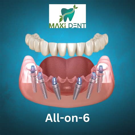 All On 6 Dental Implants Turkey Cost Dental Clinic In Antalya
