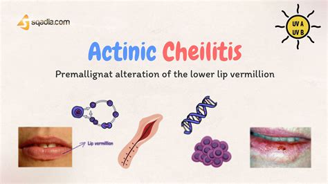 Eczematous Cheilitis