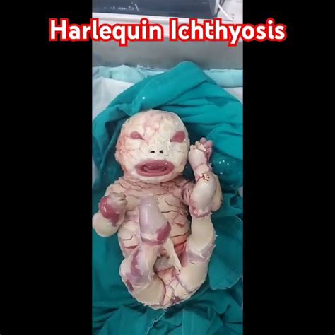 Neonatal Cases Harlequin Ichthyosis Rare Genetic Disorder Causing