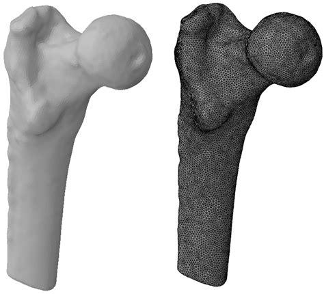 Acetabular Implant Finite Element Simulation With Customised Estimate Of Bone Properties
