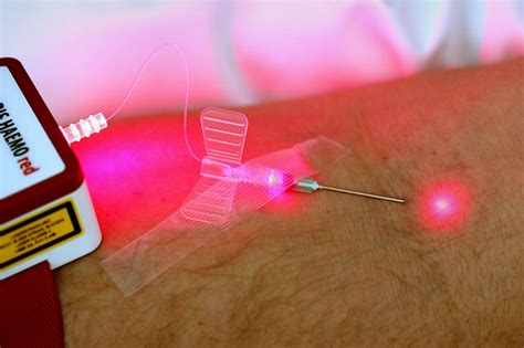 Hämo Laser Erfolgreiche Behandlung Bei Rheumaschmerzen Oberösterreich