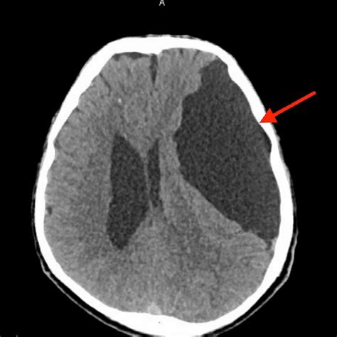 Initial Ct Head Scan Showing A Large Csf Density Extra Axial Cystic Download Scientific Diagram
