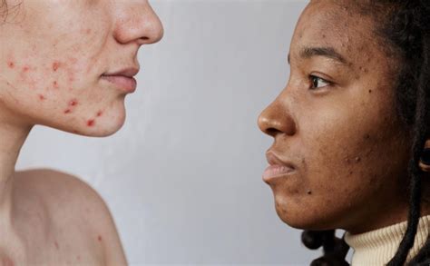 What Is Congested Skin How To Clear Congested Skin Upcircle
