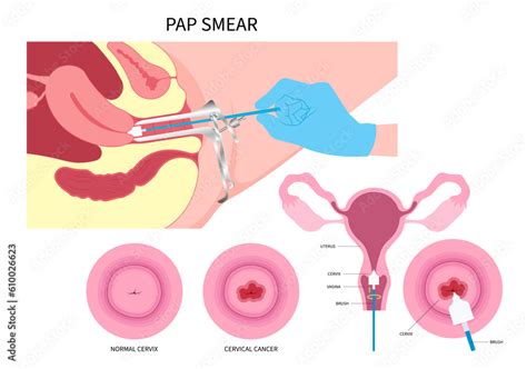 Vetor Do Stock Cervix Cancer And Examine In Women Female With