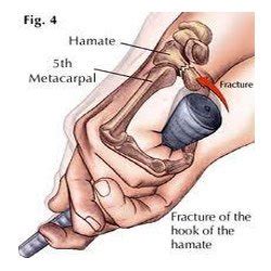Scaphoid And Hamate Fractures Move Forward Physiotherapy