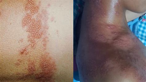 Culebrilla Características Son Los Síntomas Y Cómo Se Cura