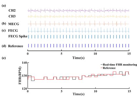 figure 1 from extraction of maternal and fetal ecg in a non invasive