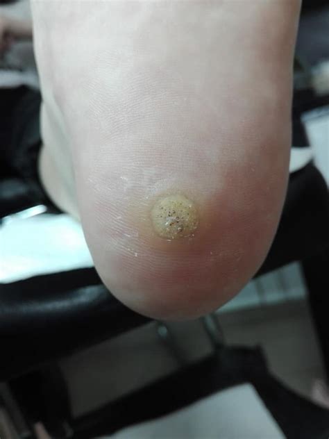 На тези снимки ви показвам един завършен цикъл на лечение на кокоши трън на моя клиентка