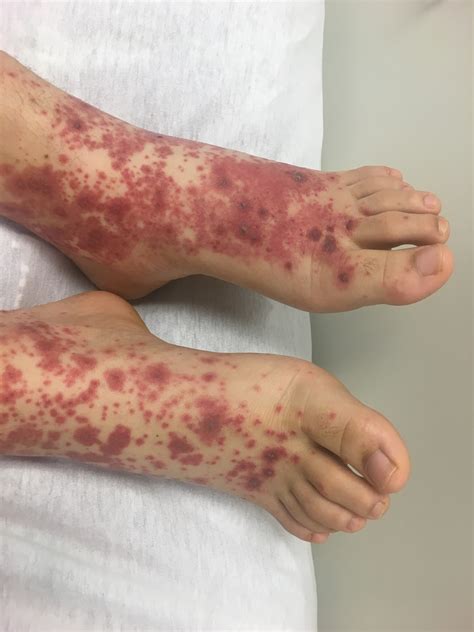 Leukocytoclastic Vasculitis Caused By Sulfamethoxazole‐trimethoprim