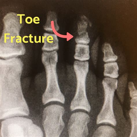 Hairline Fracture Big Toe
