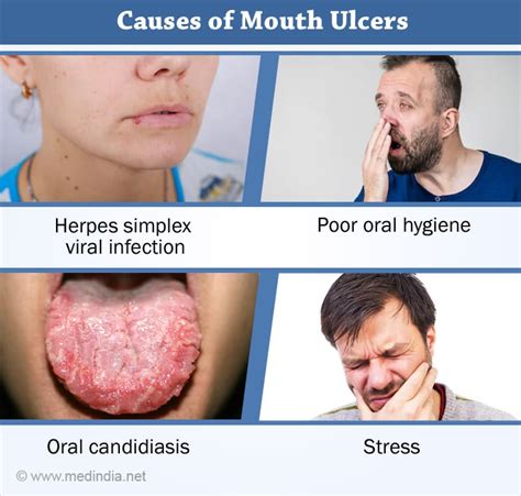 Mouth Ulcer On Tongue Causes Canker Sore On Tongue Pictures Causes