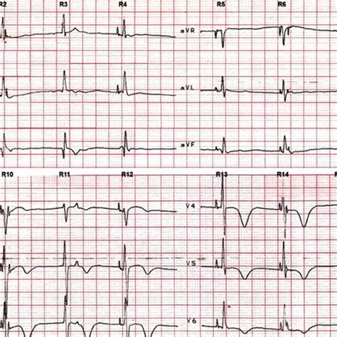 Pdf Pseudofusion In A Dual Chamber Pacemaker Is This Pacemaker