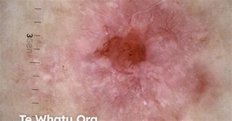 Nodular Basal Cell Carcinoma Polarised Dermoscopy View Image