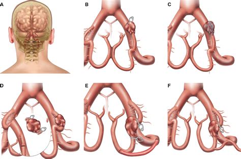 Intracranial Bypass Of Posterior Inferior Cerebellar Artery Operative Neurosurgery