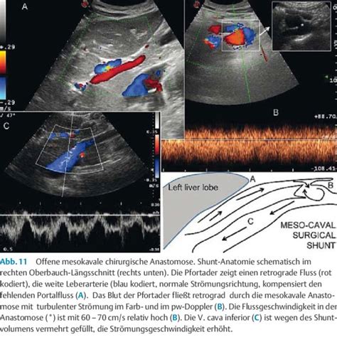 Hepatic Veins Doppler Flow Pattern Panel A Shows A Normal Triphasic