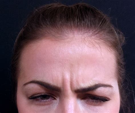 Before After Photos Wrinkle Line Reduction NYC