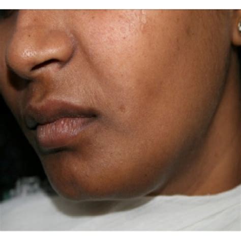 Photomicrograph Showing Diffuse Swelling On Lower Left Side Of Face Download Scientific Diagram