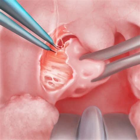 Tonsillectomy Procedure Step By Step