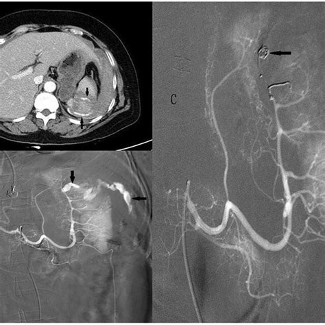 Algorithm For Management Of Patients With Blunt Splenic Injury