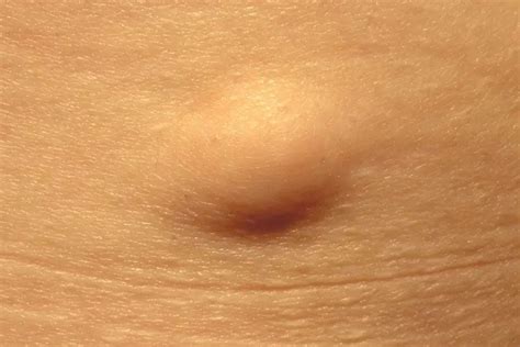 10 Common Skin Lumps With Pictures When To Worry And When To See A