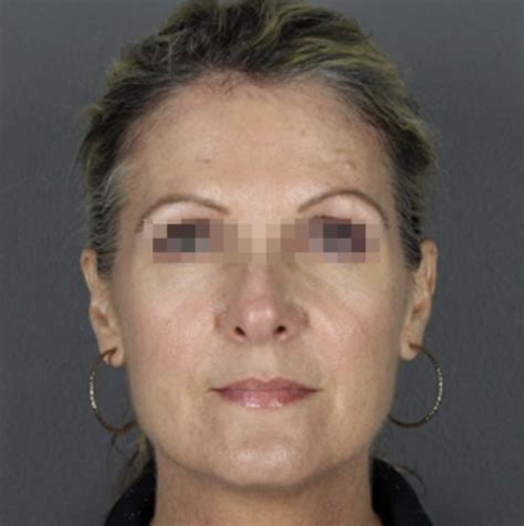 TCA Before And After Pictures In Melbourne FL Essentials Medispa Salon