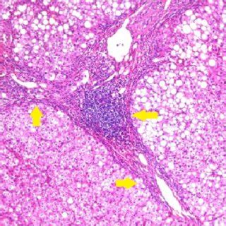 Section In Liver Tissue In A Patient With Marked Degree Of
